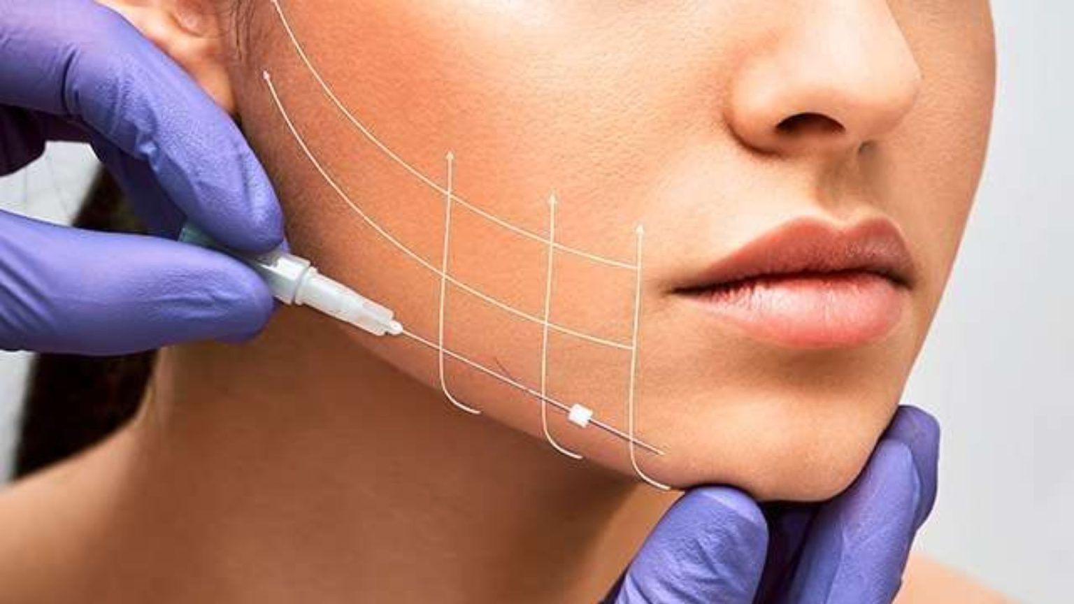 ¿Qué son los Hilos Tensores PDO? - Dr. Juan Pablo Alvarez